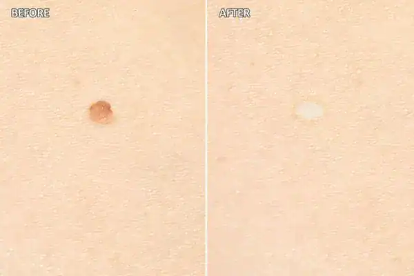 Benign Mole Removal in , UK LipoFreeze2U Book Now