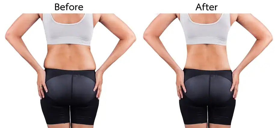 Back Toning Treatment and Body Toning in , UK